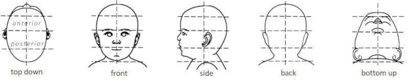 Head Shape Info | Steinmann Prosthetics & Orthotics