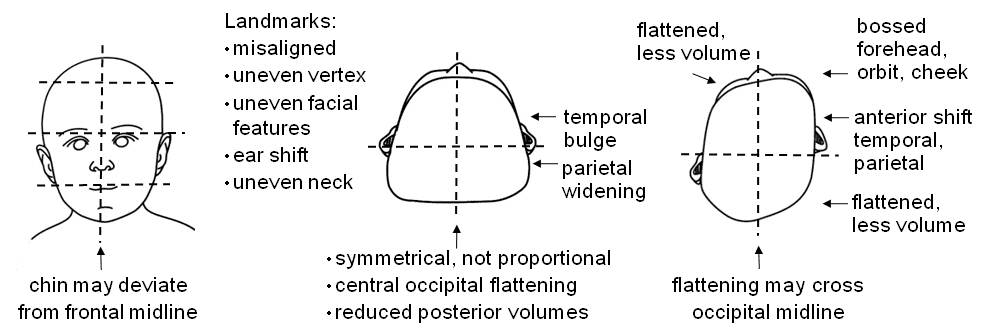 Supporting Your Baby’s Head Shape: Early Evaluation for Plagiocephaly ...