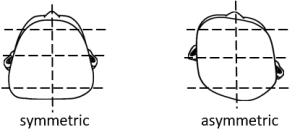 head shape, plagiocephaly, craniosynostosis, torticollis, brachycephaly ...
