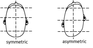 head shape, plagiocephaly, craniosynostosis, torticollis, brachycephaly ...