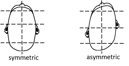 head shape, plagiocephaly, craniosynostosis, torticollis, brachycephaly ...