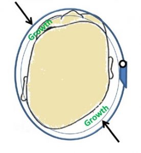 cranial molding orthoses Steinmann Prosthetics & Orthotics